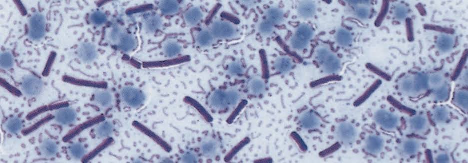 Anthrax - Symptoms Causes, Treatments