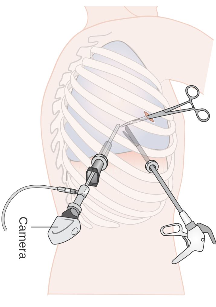 Faster and Better Outcomes with VATS and RATS Techniques